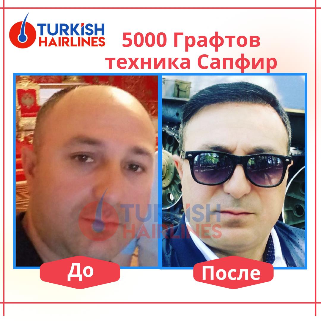 Turkish Hairline