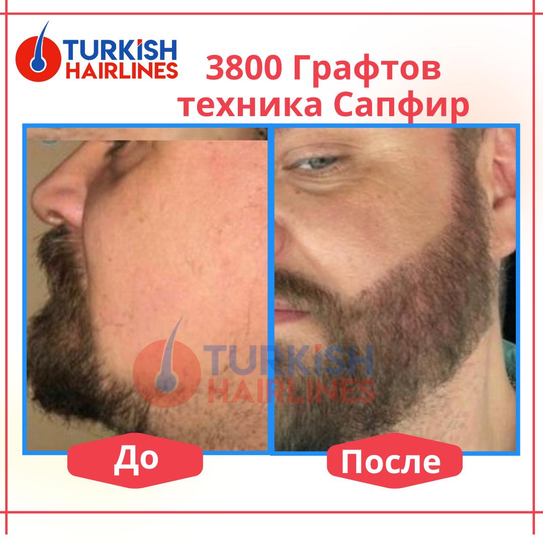 Turkish Hairline